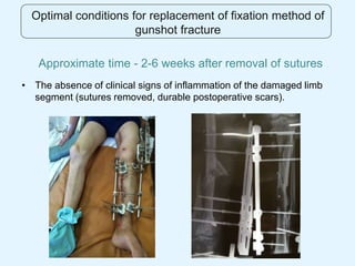 Gunshot injuries of extremities | PPTX