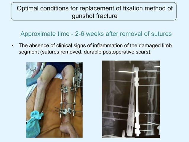Gunshot injuries of extremities | PPT