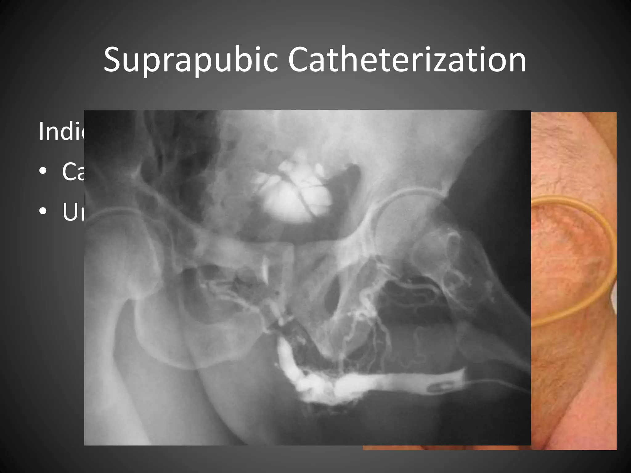 Urologic Procedures in the Emergency Department | PPTX