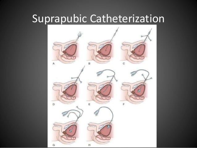 Urologic Procedures in the Emergency Department