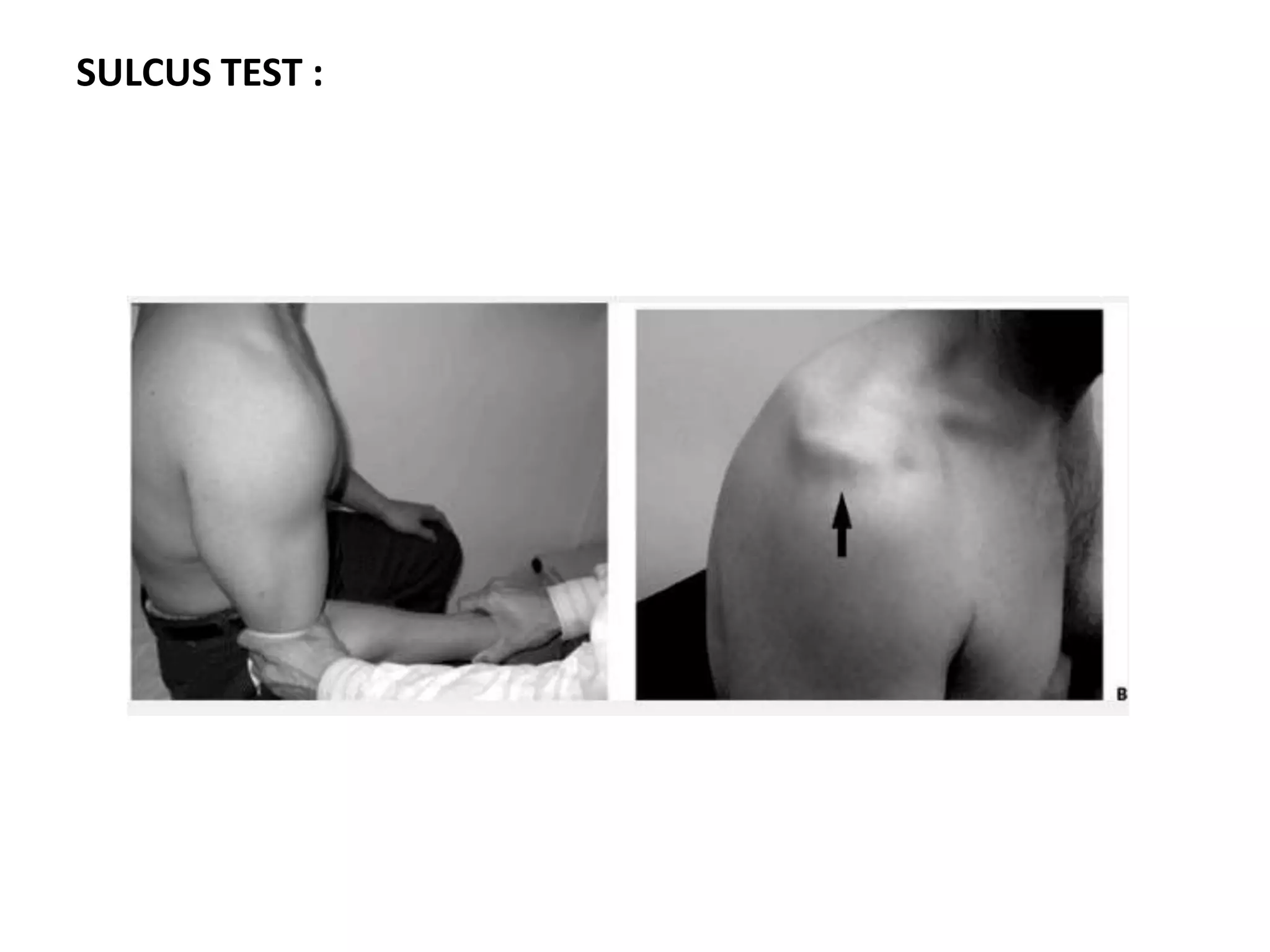 dislocations of shoulder dr.guru prasad | PPTX