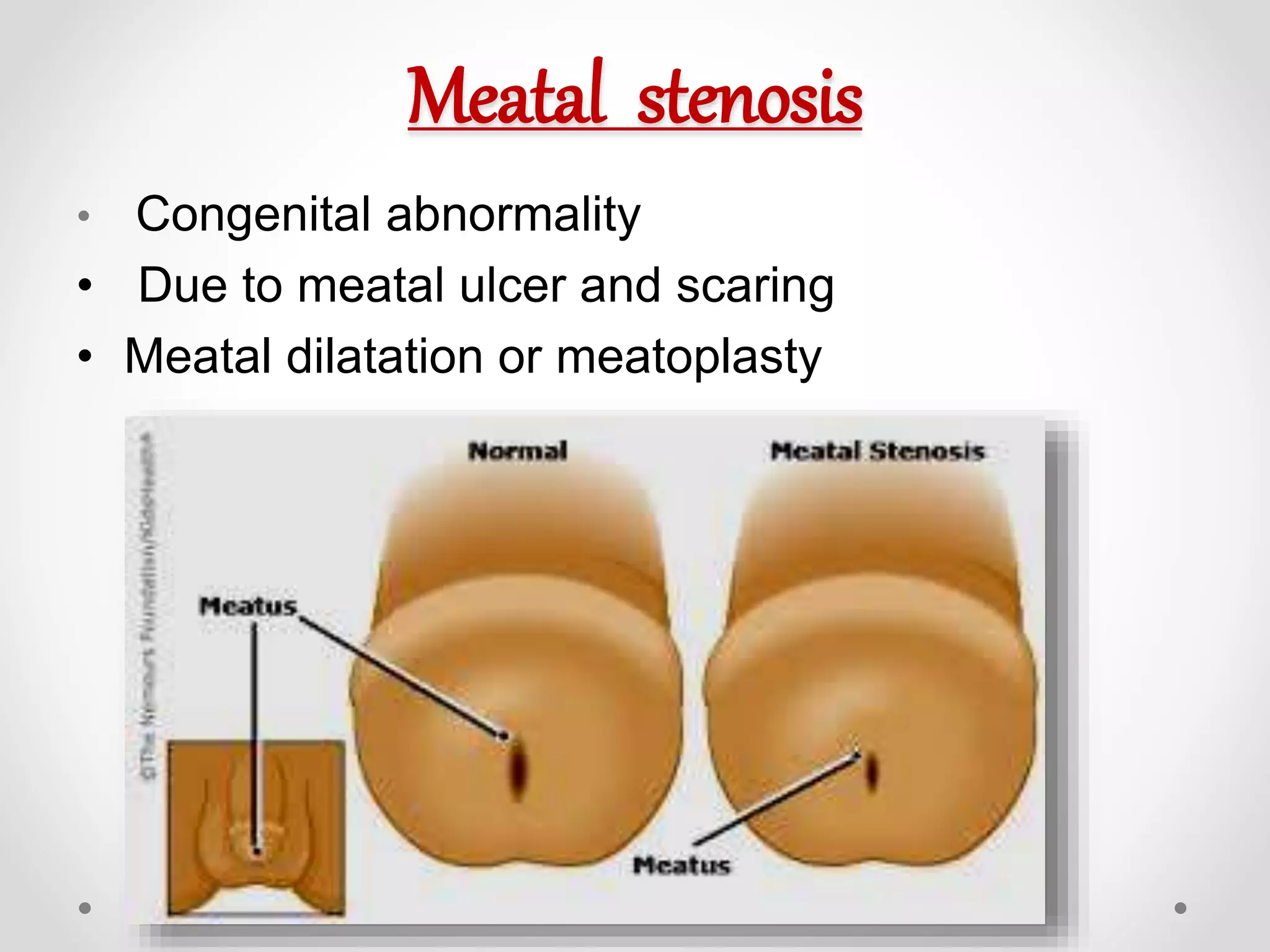 Disorders Of Gu System By Abhi Pptx
