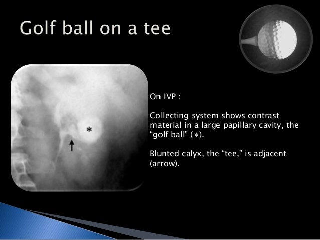 Genitourinary Tuberculosis