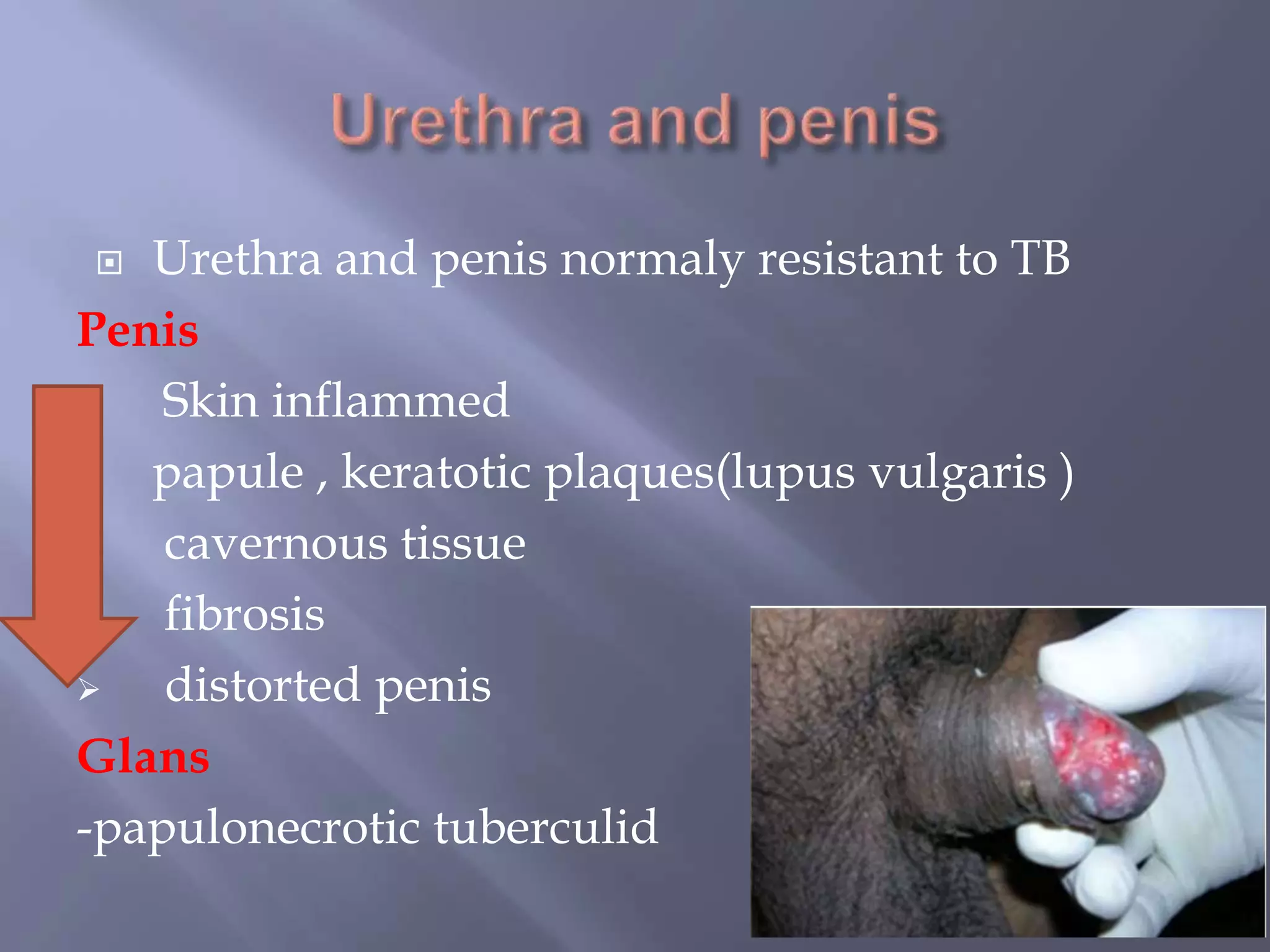 Genitourinary tuberculosis -2020 | PPTX