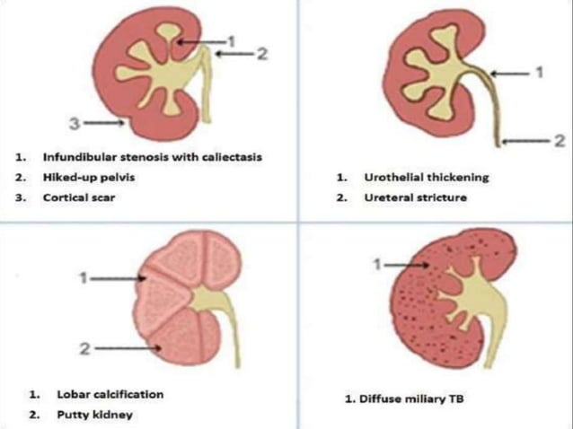 Genitourinary tuberculosis -2020 | PPTX | Digestive Disorders | Diseases and Conditions
