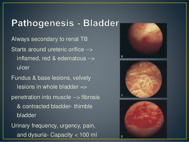Gentiurinary tuberculosis