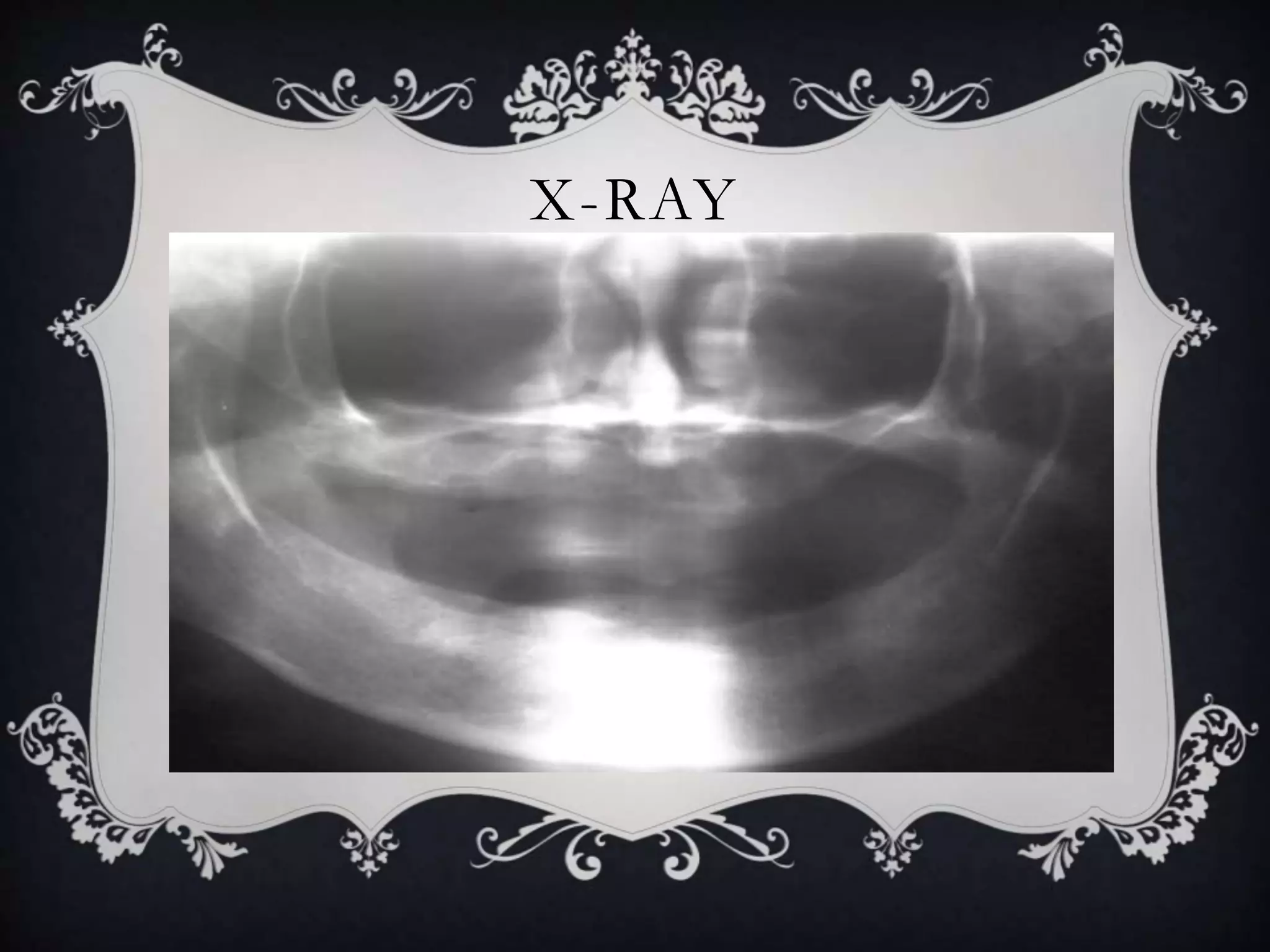 epulis fissuratum | PPTX