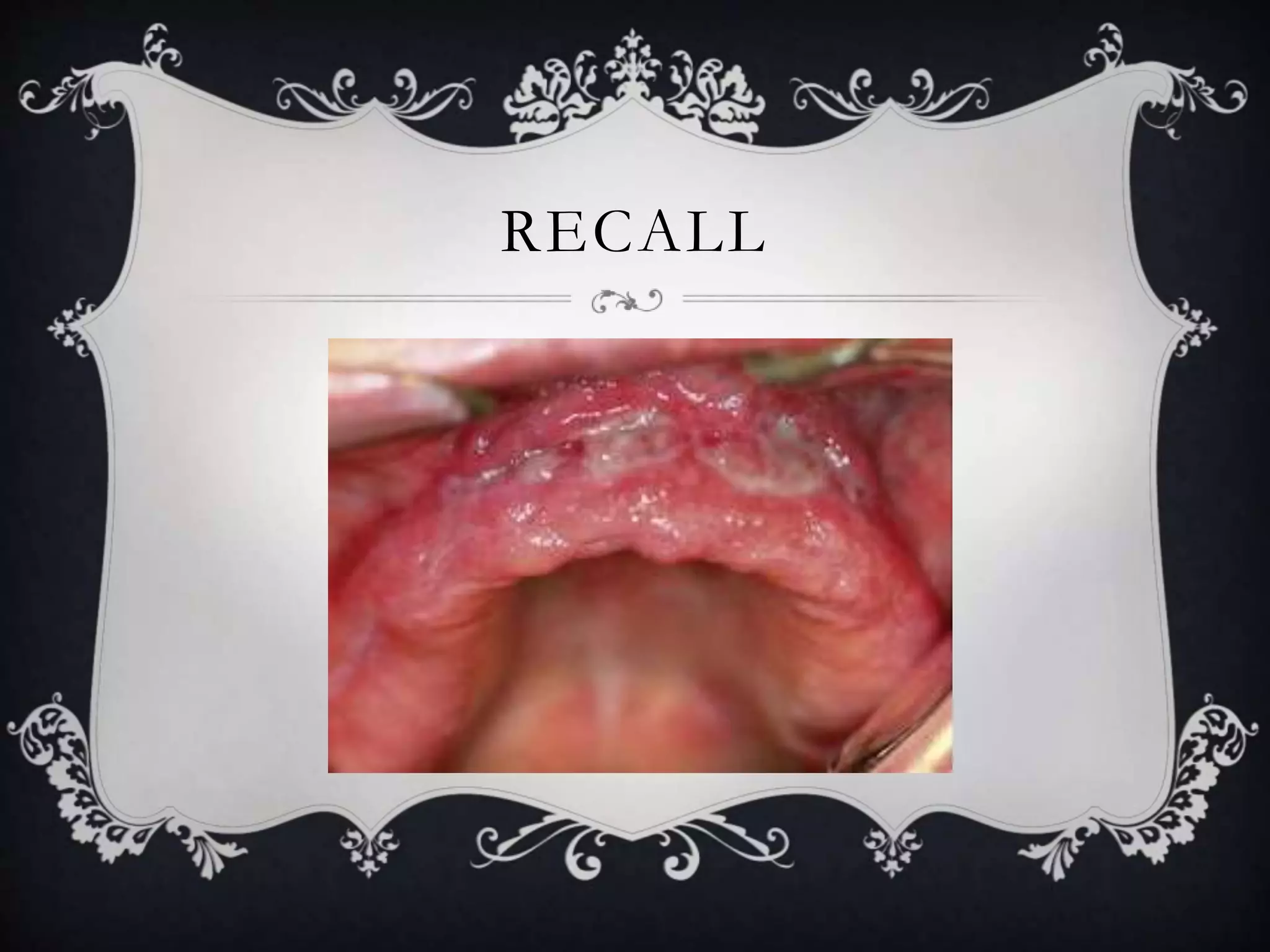 epulis fissuratum | PPTX