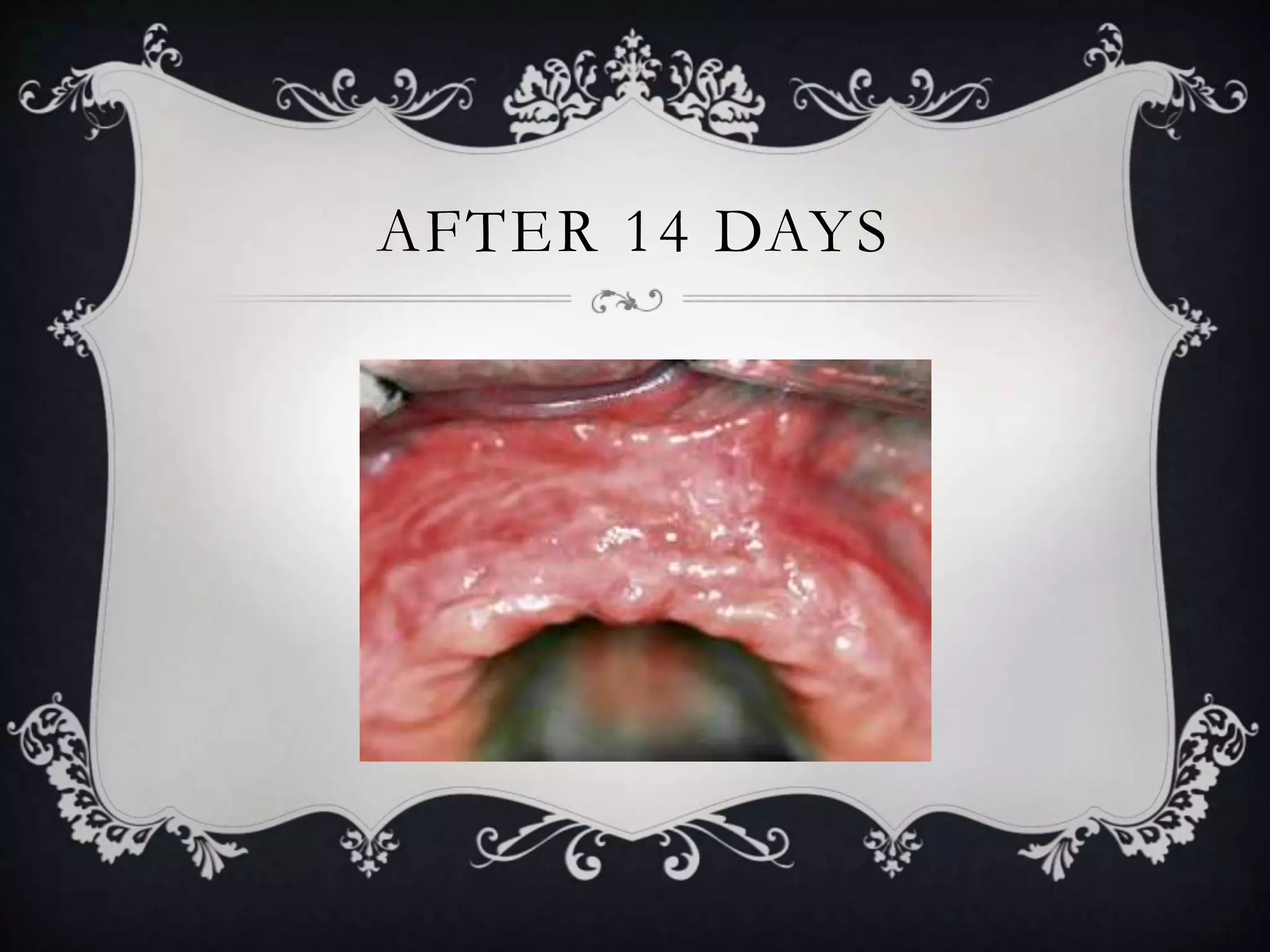 epulis fissuratum | PPTX