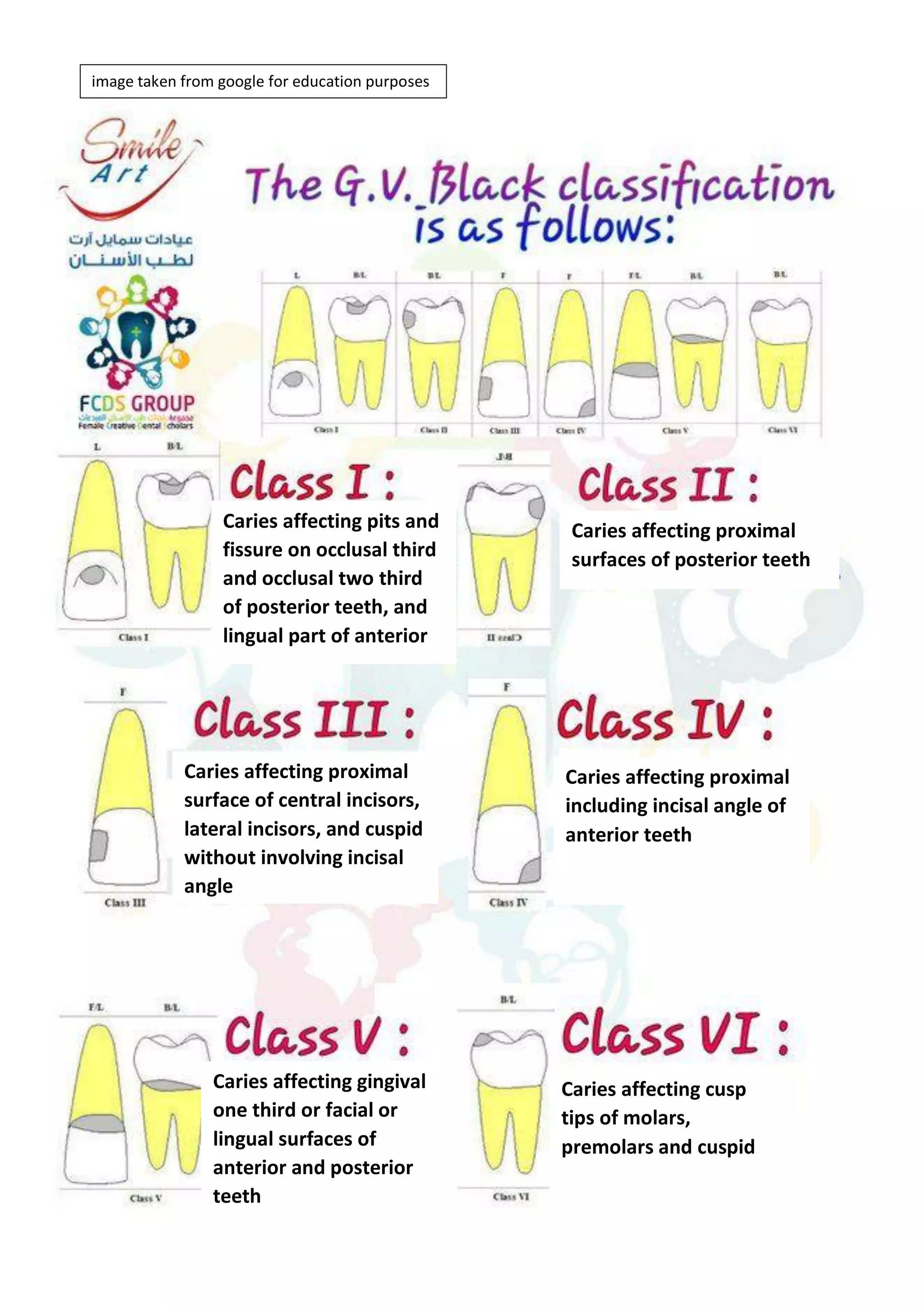 Gv black classification of caries | PDF