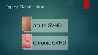 GVHD.pptx