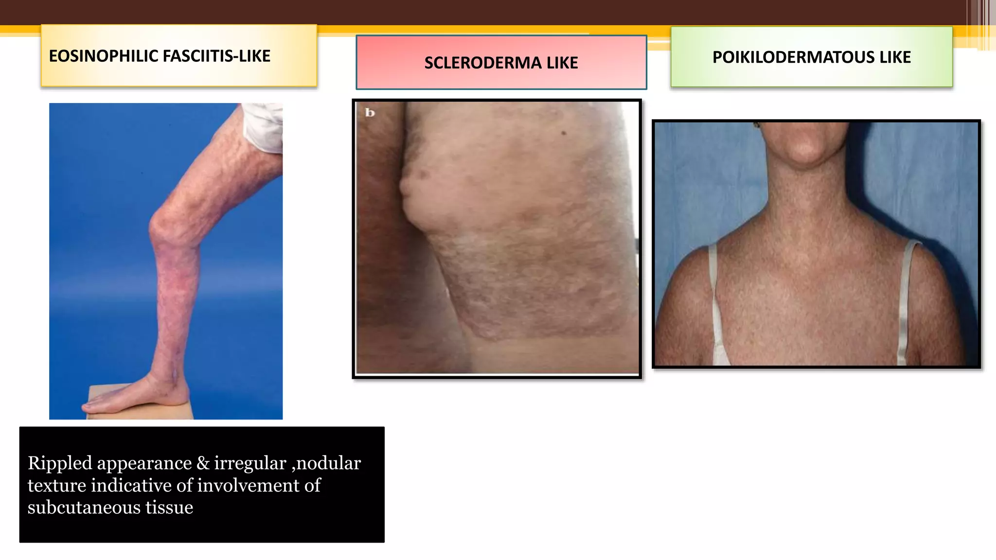 GVHD - tutorial.pptx