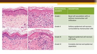 GVHD - tutorial.pptx