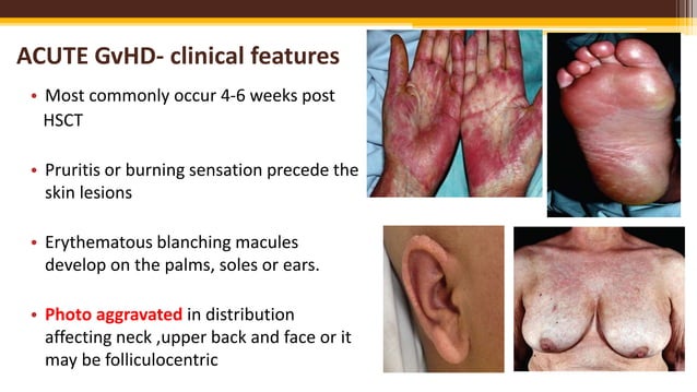 GVHD - tutorial.pptx | Blood Disorders | Diseases and Conditions