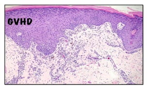 GVHD - tutorial.pptx