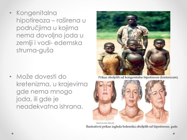 Štitasta zlezda | PPT