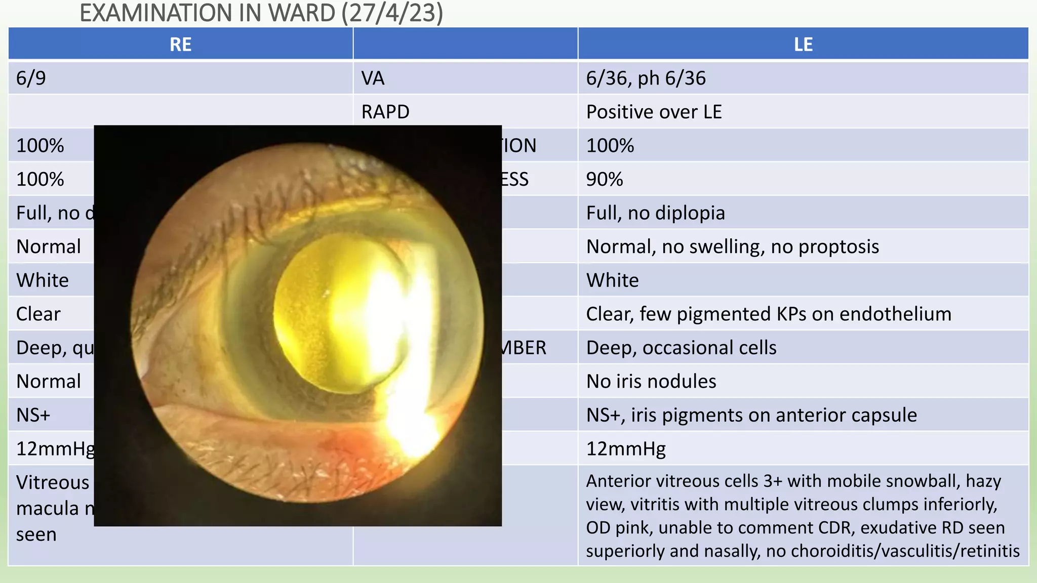GWR LE panuveitis.pptx