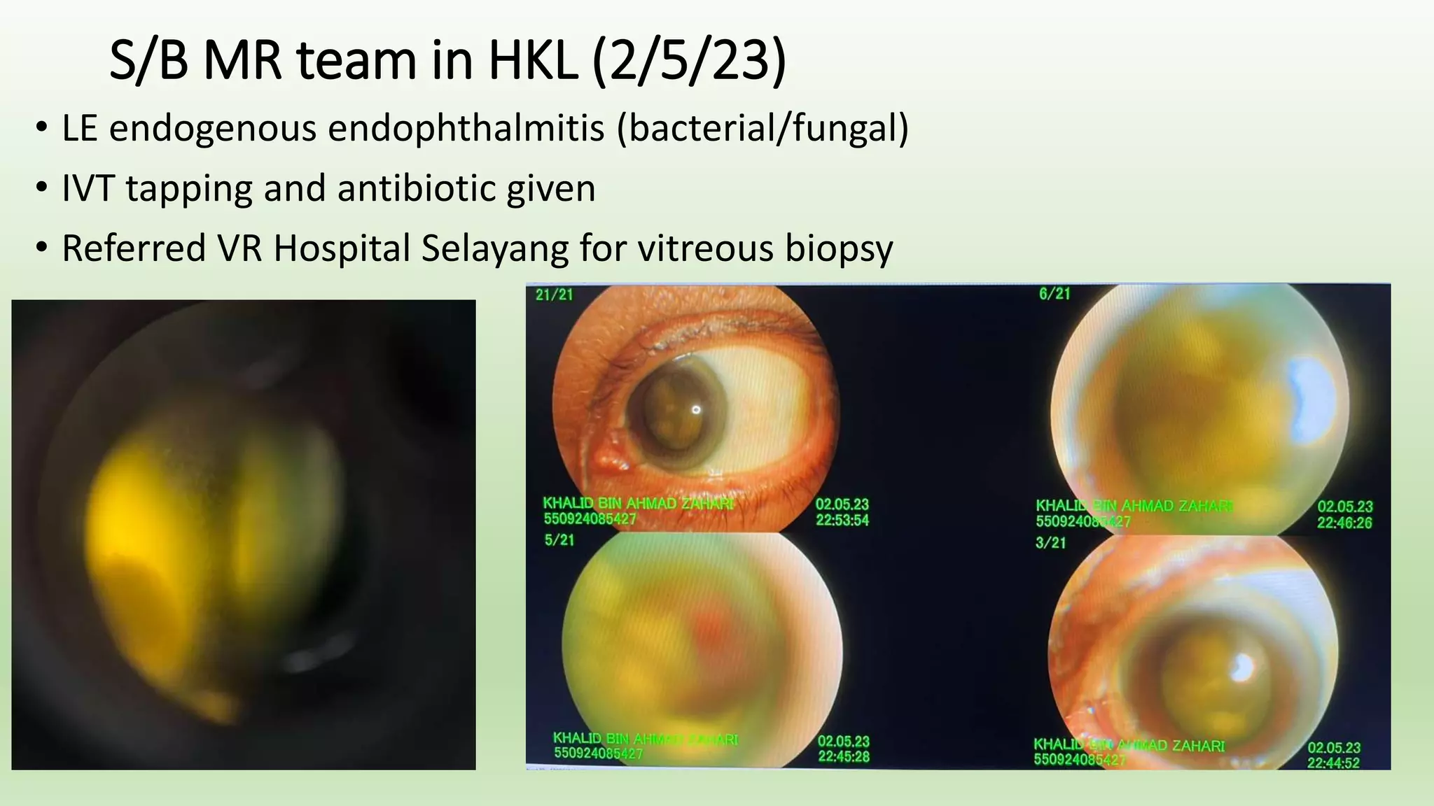 GWR LE panuveitis.pptx