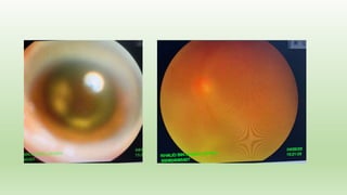 GWR LE panuveitis.pptx