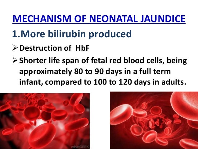 Physiological Neonatal Jaundice
