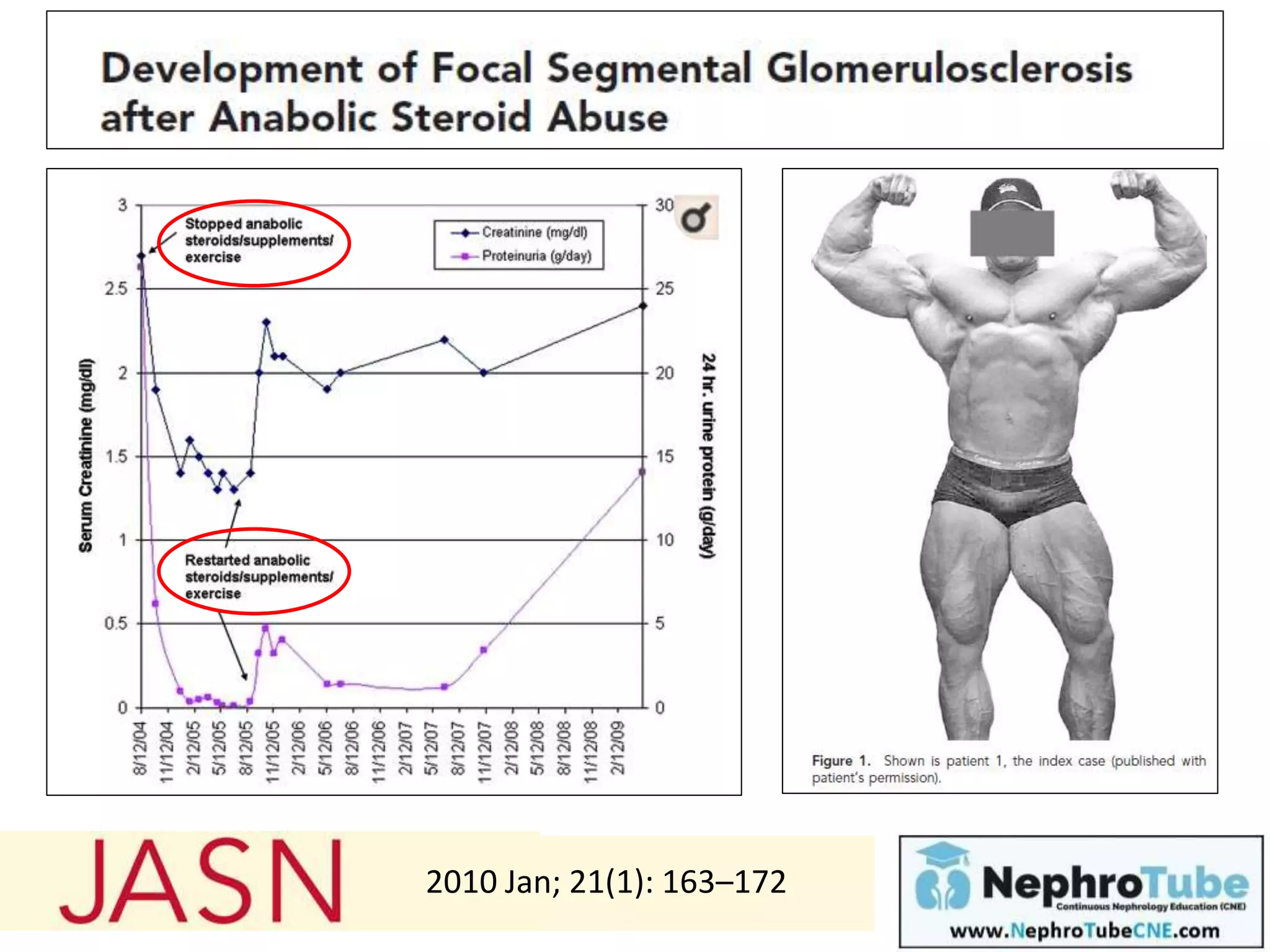 Gym nephropathy (bodybuilding vs. kidney damaging) - Dr. Gawad | PPTX