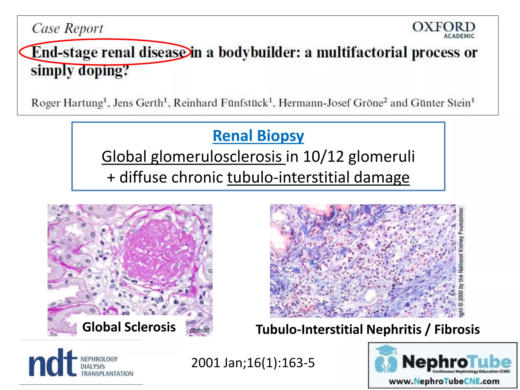 Gym nephropathy (bodybuilding vs. kidney damaging) - Dr. Gawad | PPTX
