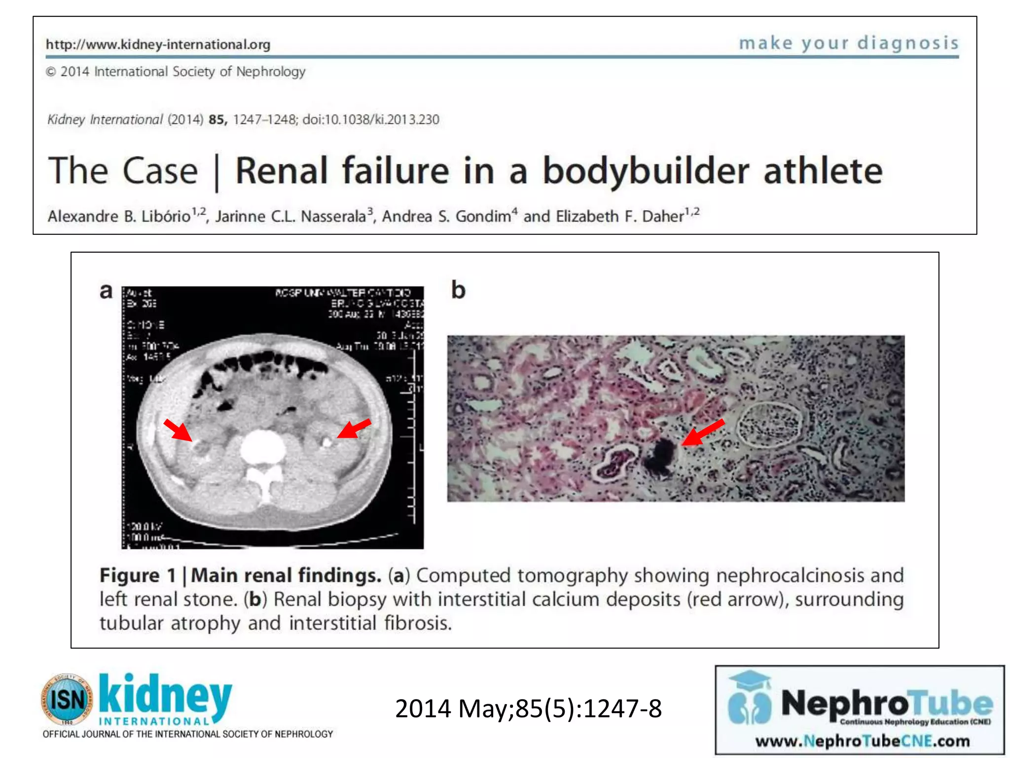 Gym nephropathy (bodybuilding vs. kidney damaging) - Dr. Gawad | PPTX
