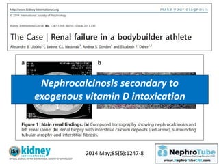 Gym nephropathy (bodybuilding vs. kidney damaging) - Dr. Gawad | PPTX