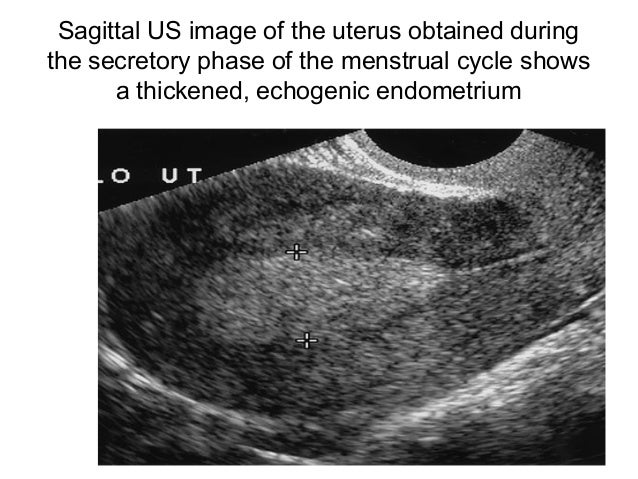Menstrual Cycle Ultrasound