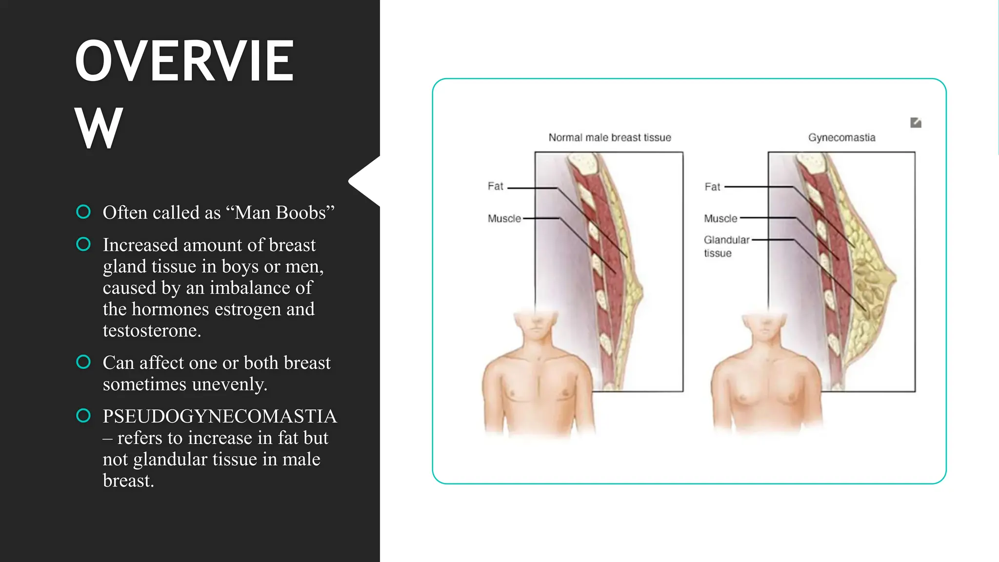 Gynaecomastia.pptx
