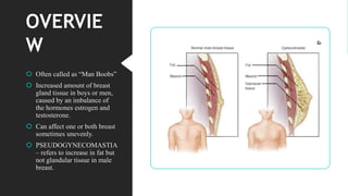 Gynaecomastia.pptx