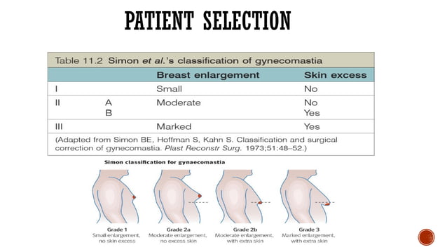 GYNAECOMASTIA- diagnosis and management. | PPT