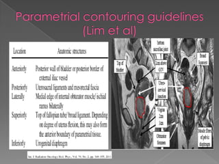 Contouring Guidelines for Gynecological Malignancy | PPTX