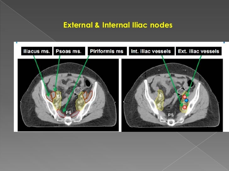 Contouring Guidelines for Gynecological Malignancy