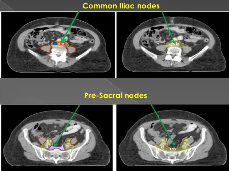 Contouring Guidelines for Gynecological Malignancy