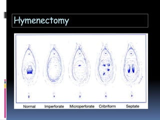 Gynae surgeries | PDF