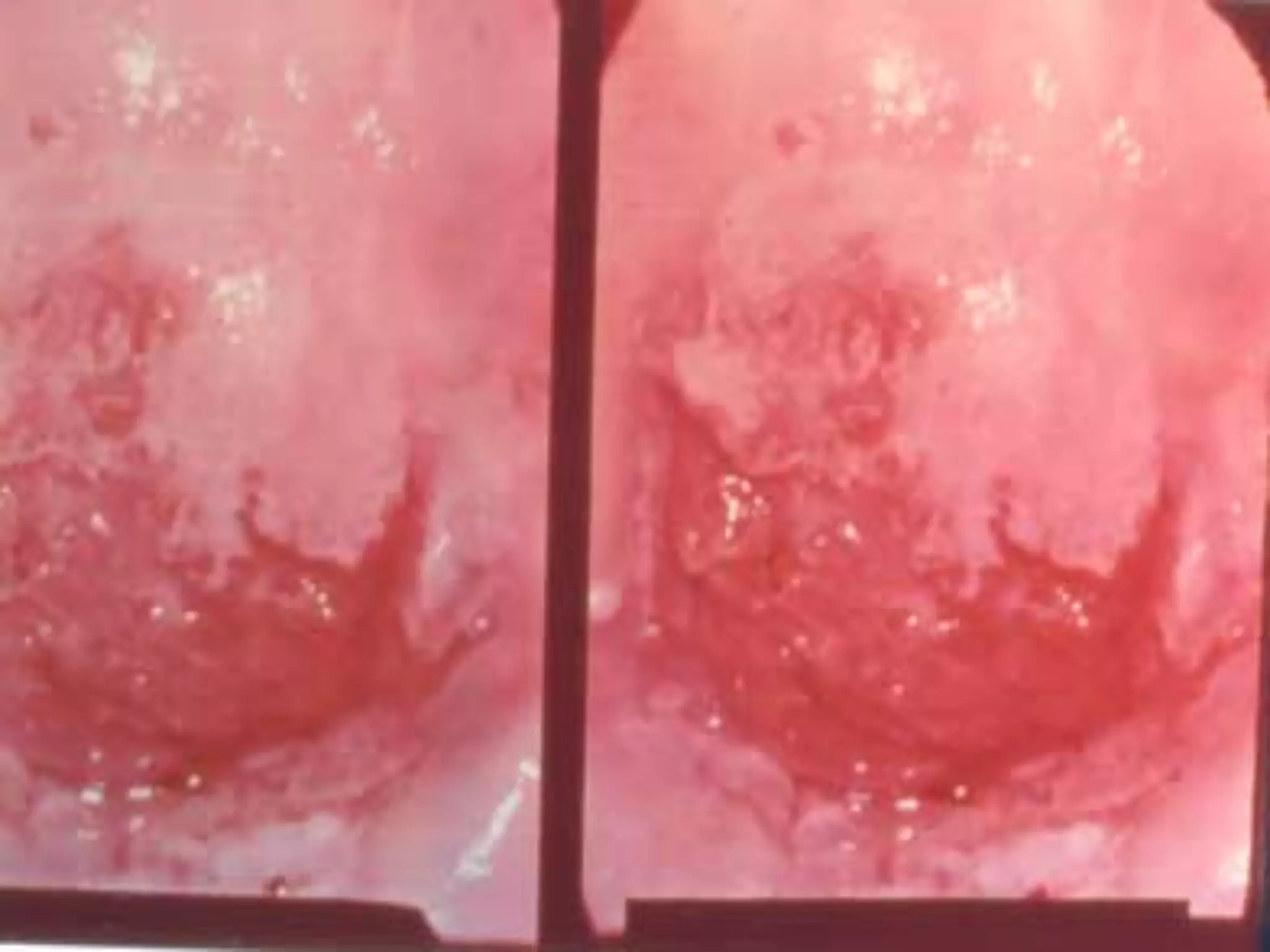 Gyne procedure | PDF