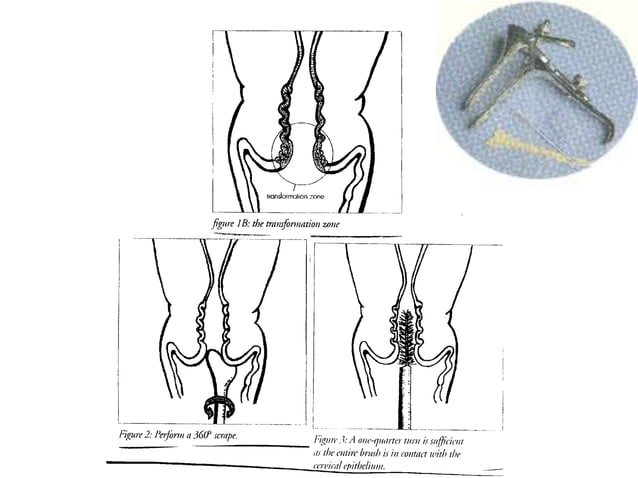 Gyne procedure | PDF | Reproductive Health | Diseases and Conditions
