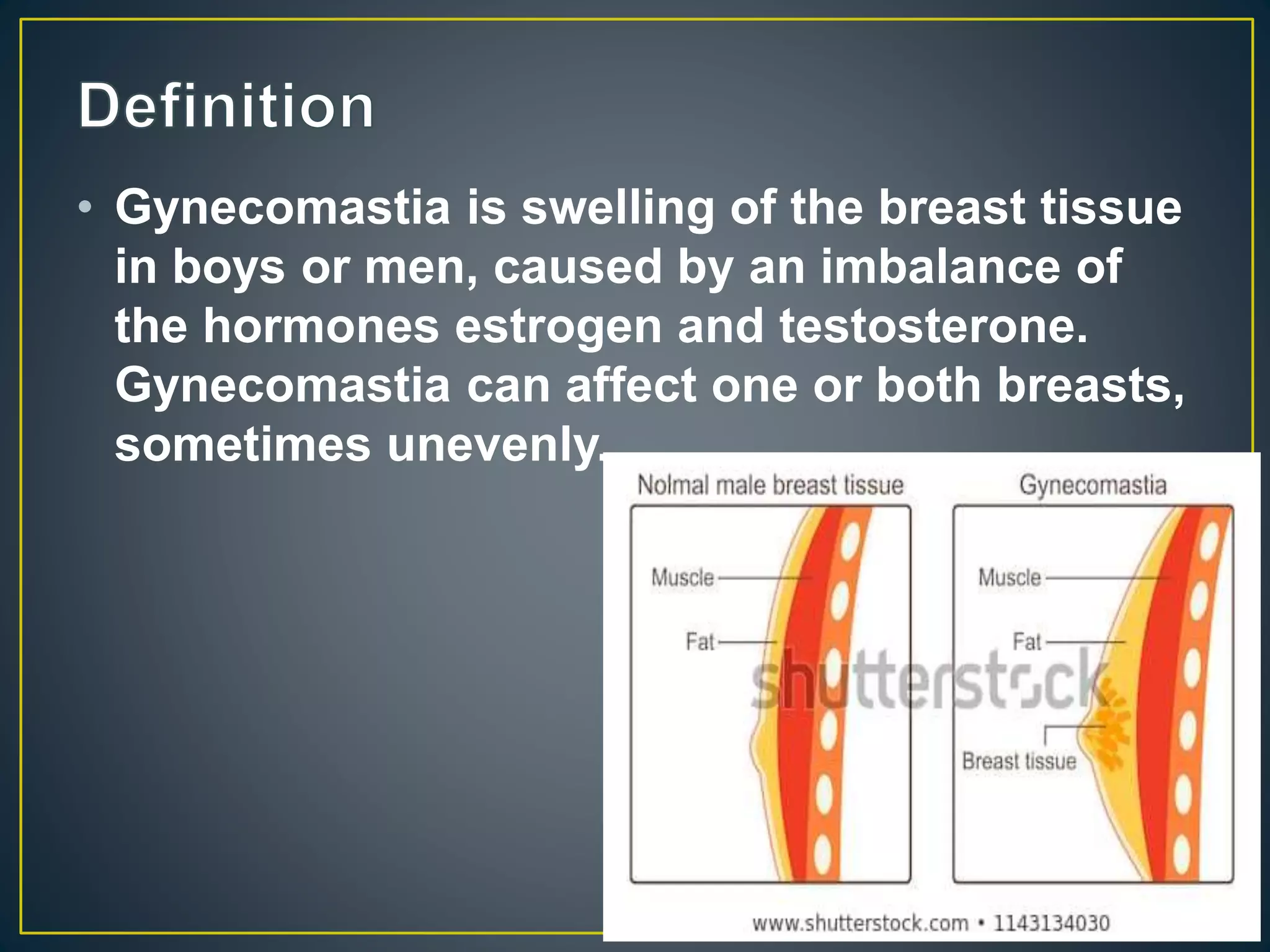 Gyneacomastia | PPTX