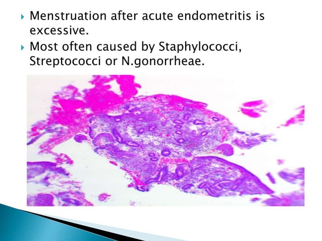 ENDOMETRITIS | PPT