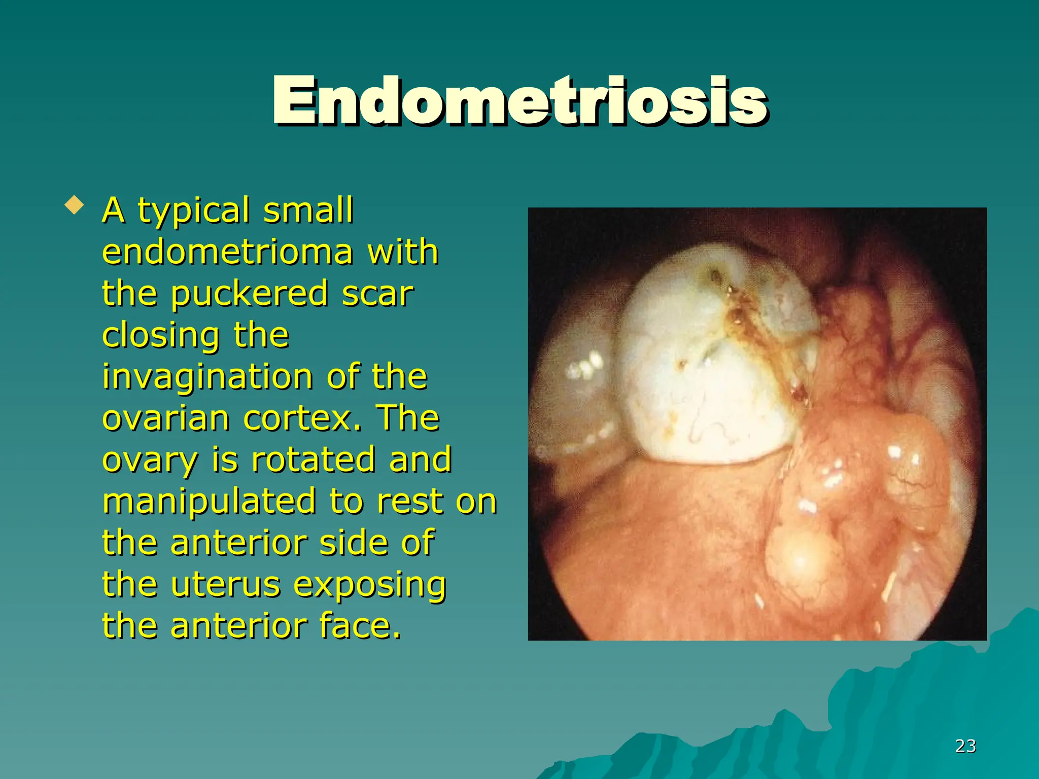 Gynecological Laparoscopy powerpoint slide | PPT