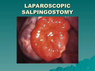 Gynecological Laparoscopy powerpoint slide | PPT