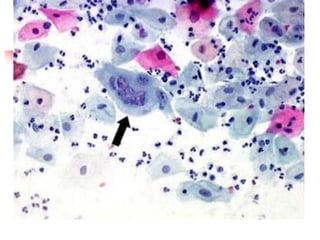 GYNECOLOGICAL CYTOLOGY inflammatory pap smear | PDF