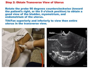 Gynecology Ultrasound PDF 11 (1). female pelvic ultrasound pdf | PDF