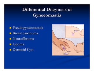 Gynecomastia | PDF