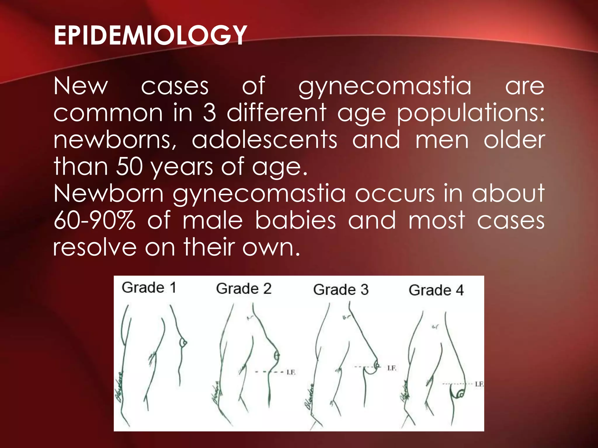 Gynecomastia surgery ppt | PPTX
