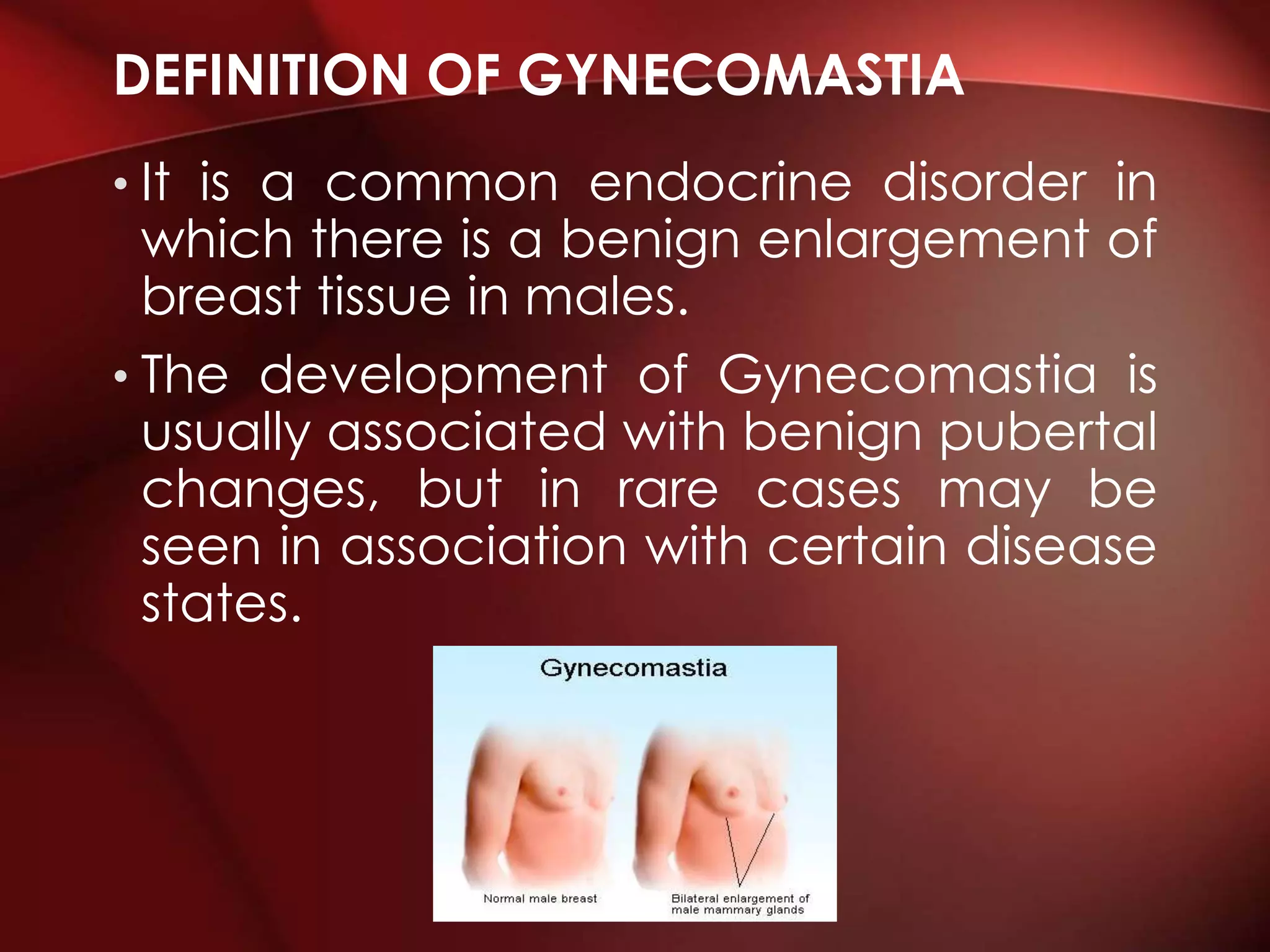 Gynecomastia surgery ppt | PPTX