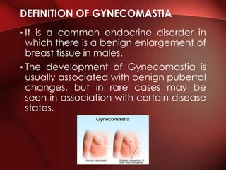 Gynecomastia surgery ppt | PPTX