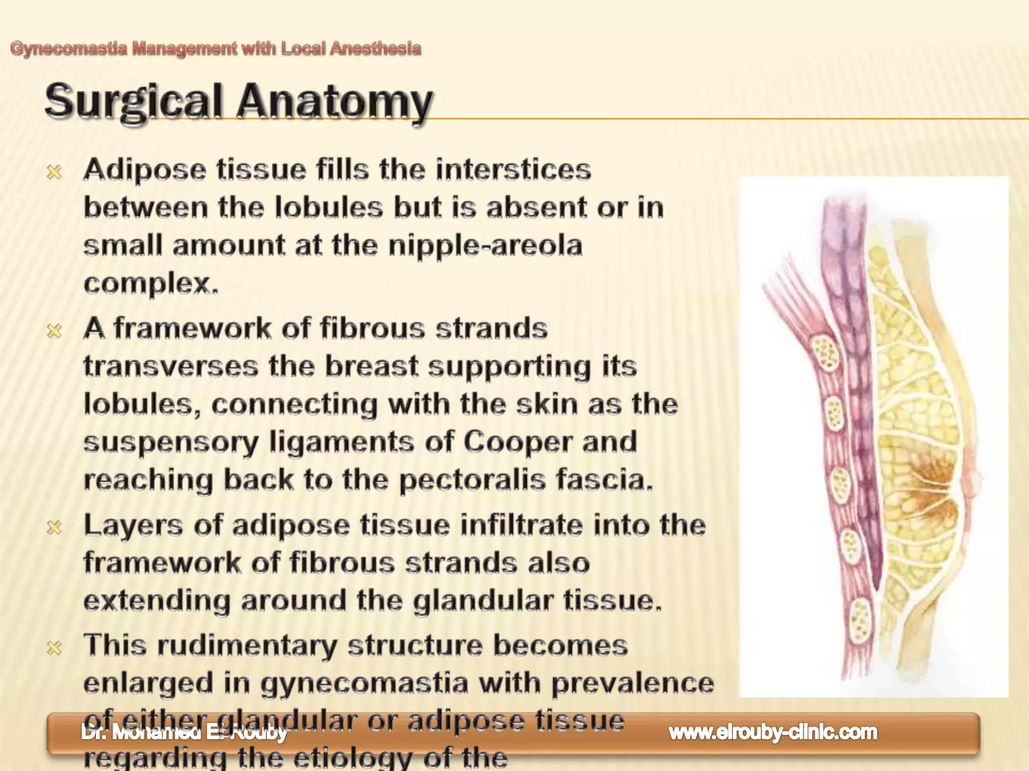 Gynecomastia with local anesthesia | PPT