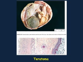 gynecopathology post pathology of ovary.pdf